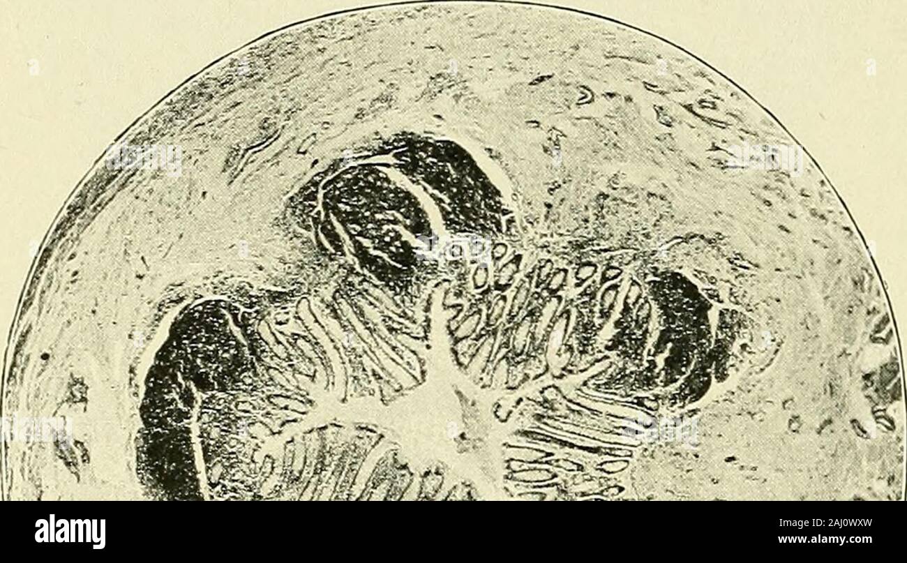 Appendicitis : its pathology and surgery . Fig. 30.—Streptococci in ...