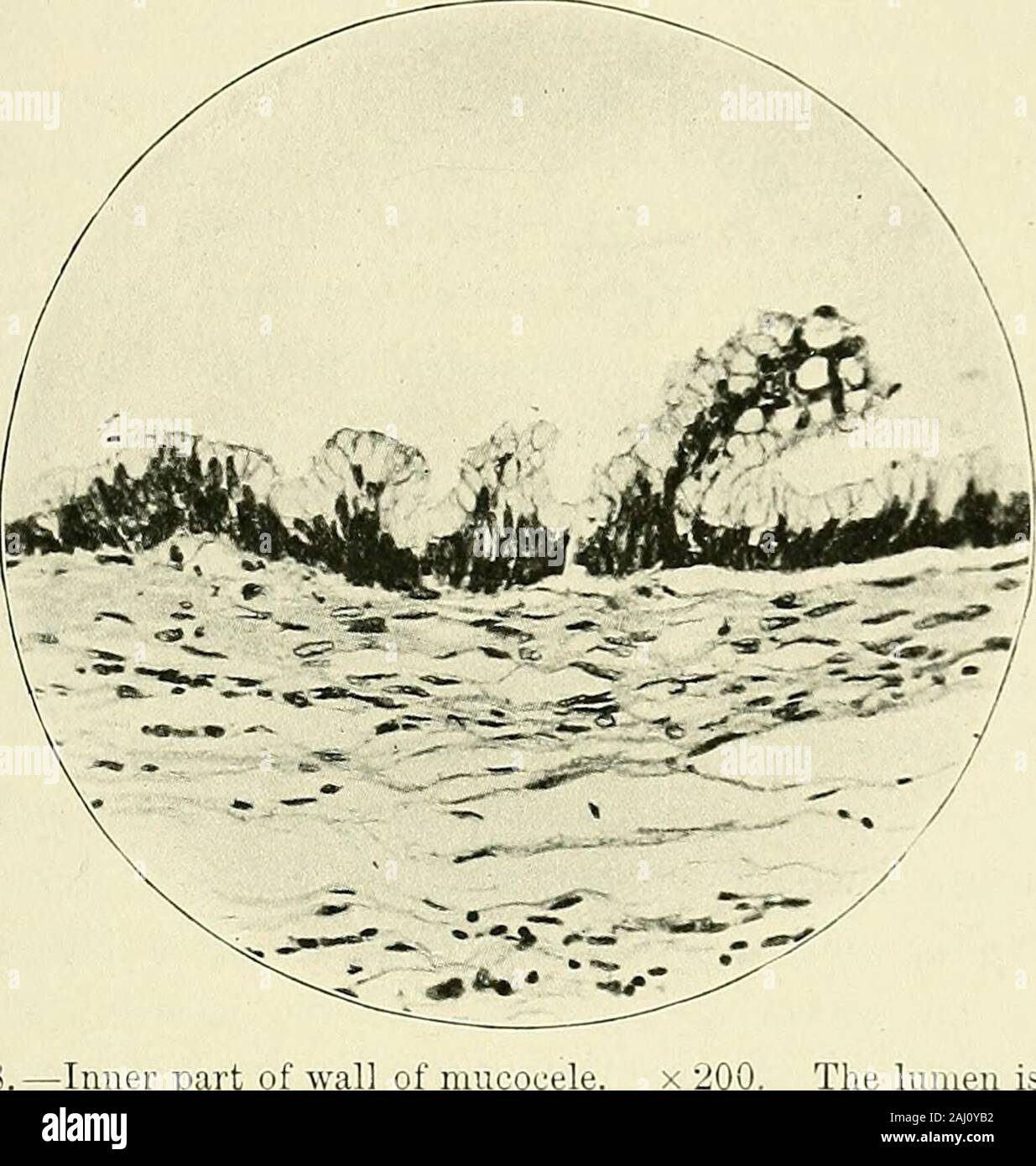 Complications of appendicitis hi-res stock photography and images - Alamy