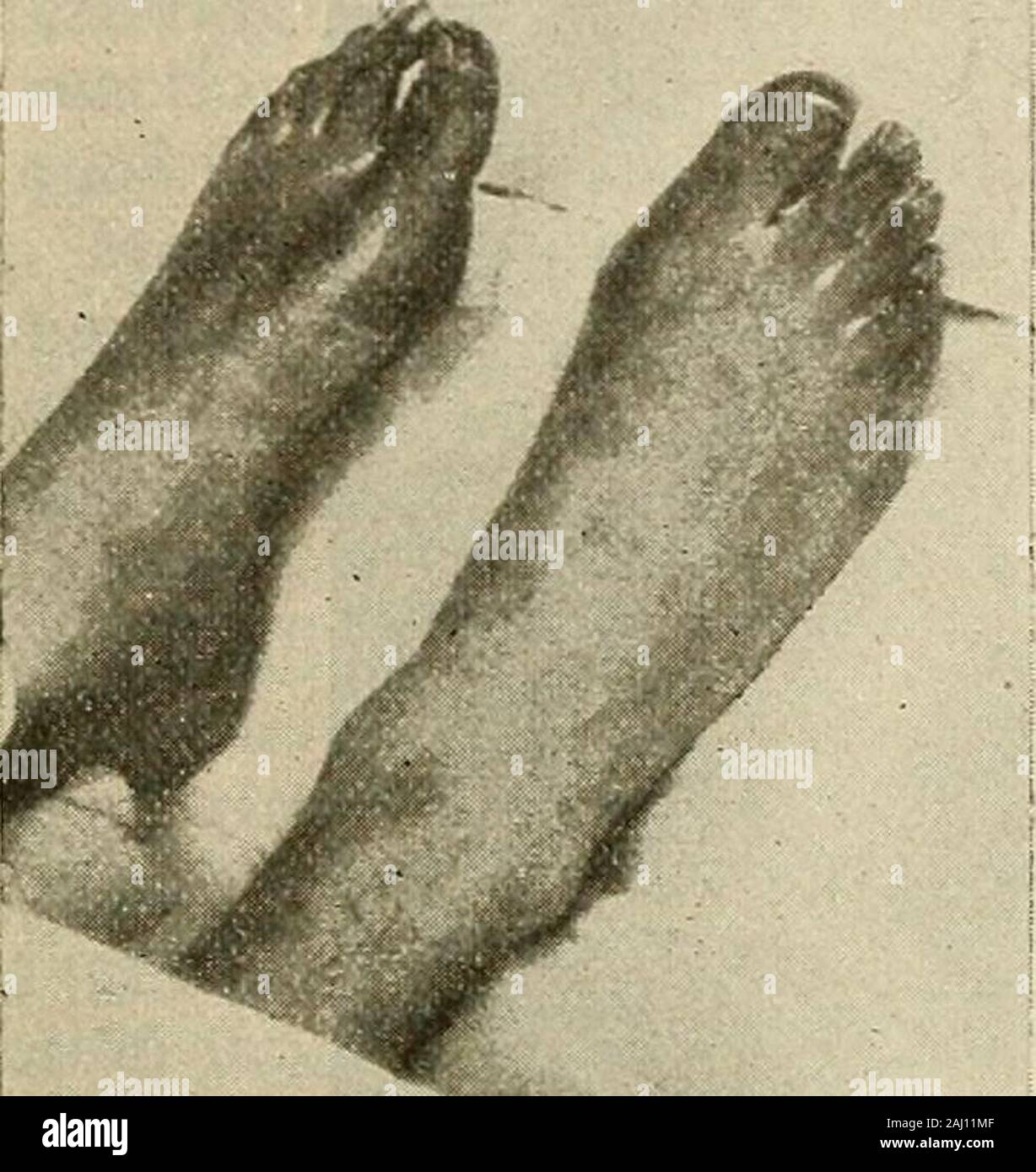 Line Of Demarcation Gangrene