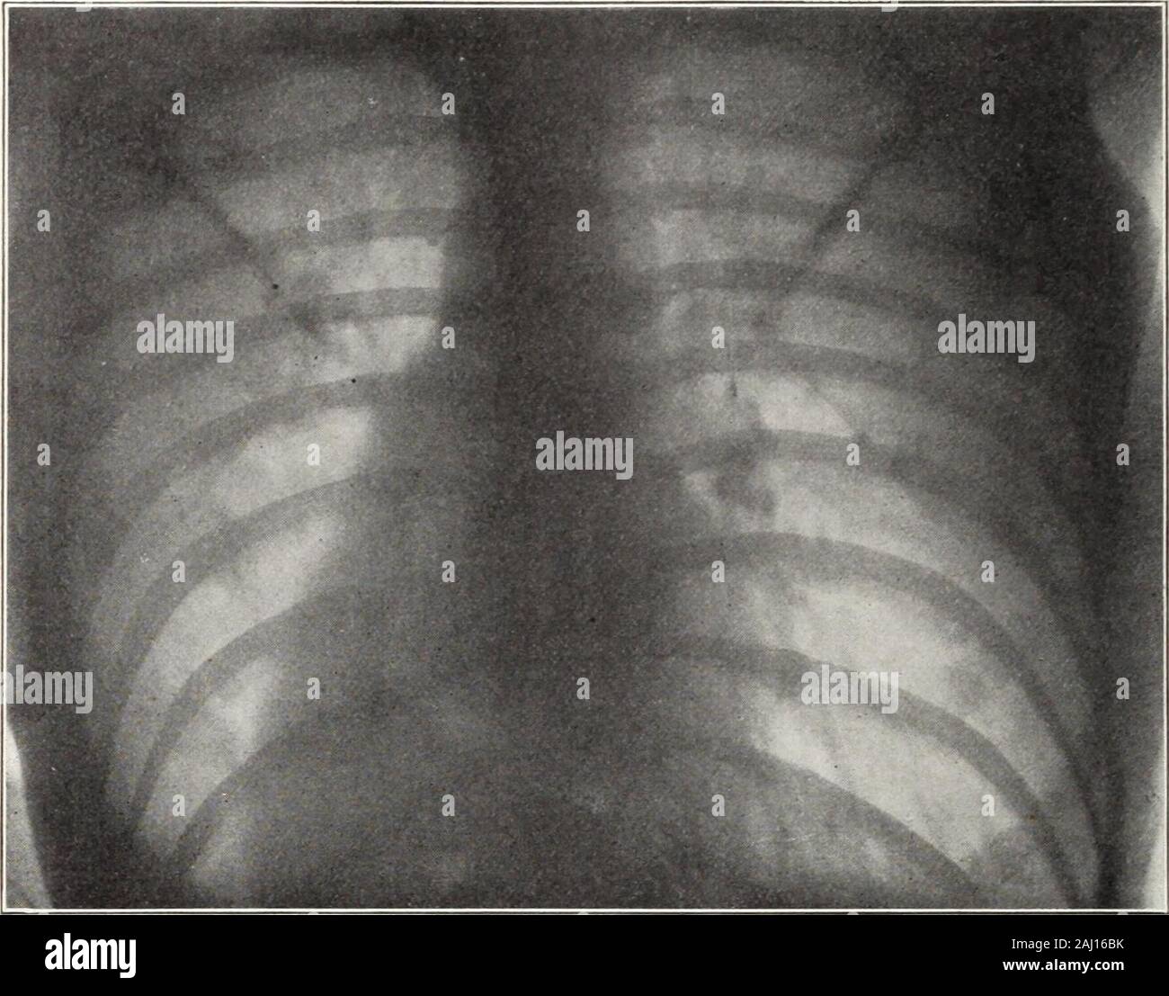 Lymph Nodes Enlarged Heart