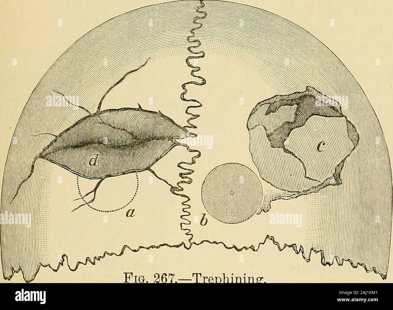 Operative surgery . Fig. 266.—Circular craniotomy (trephining).. Fig ...