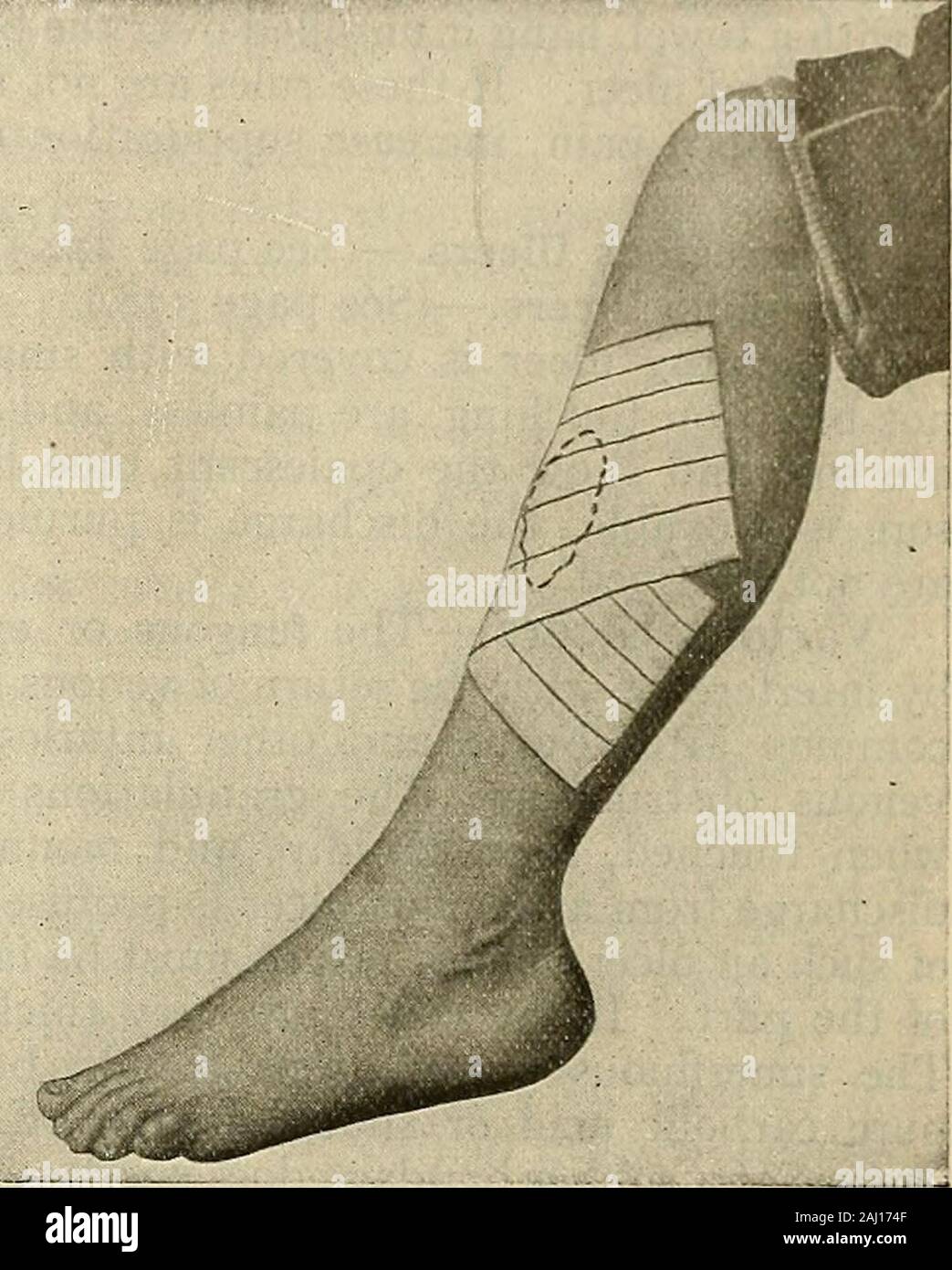 Modern surgery, general and operative . granulations (proud flesh ...