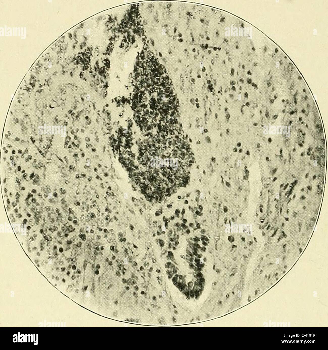 Appendicitis : its pathology and surgery . li, short, thick bacilli ...