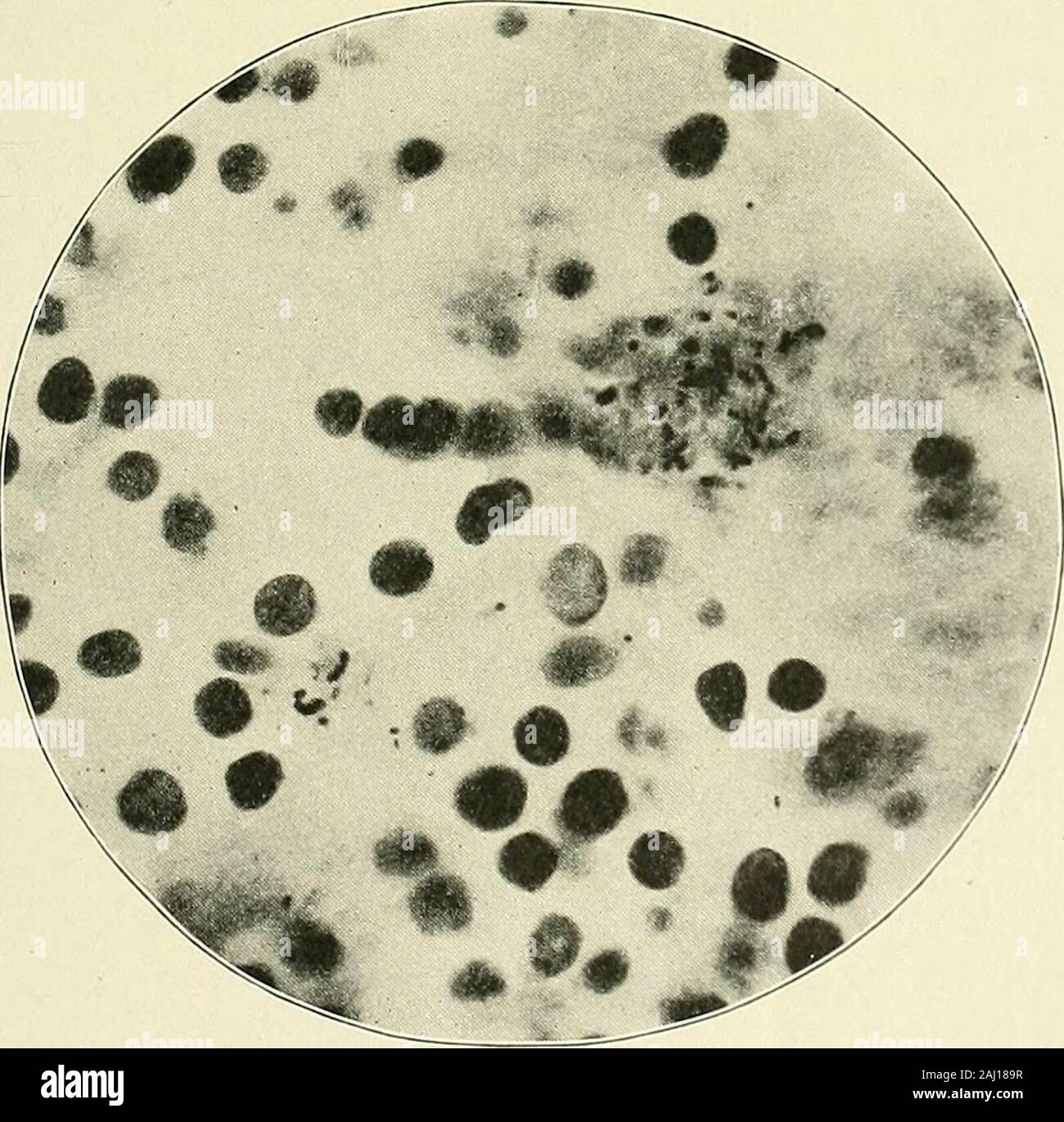 Appendicitis : its pathology and surgery . Fig. 11.—Part of the lumen ...