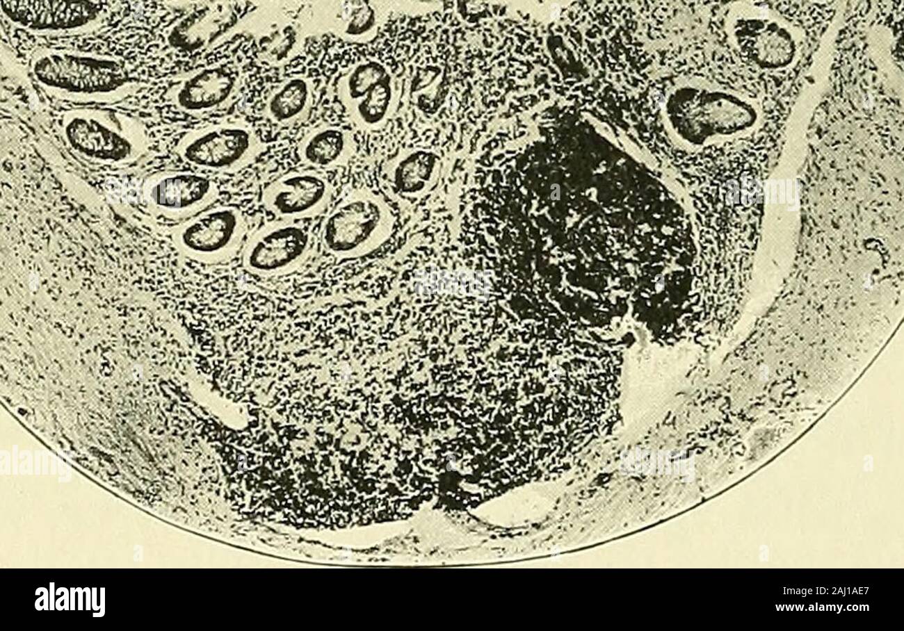 Appendicitis : its pathology and surgery . -Ulceration of the mucosa ...