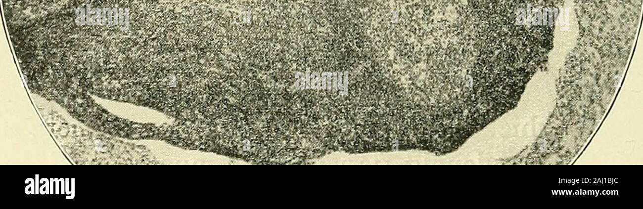 Appendicitis : its pathology and surgery . k. Fig. 5.—Normal appendix ...