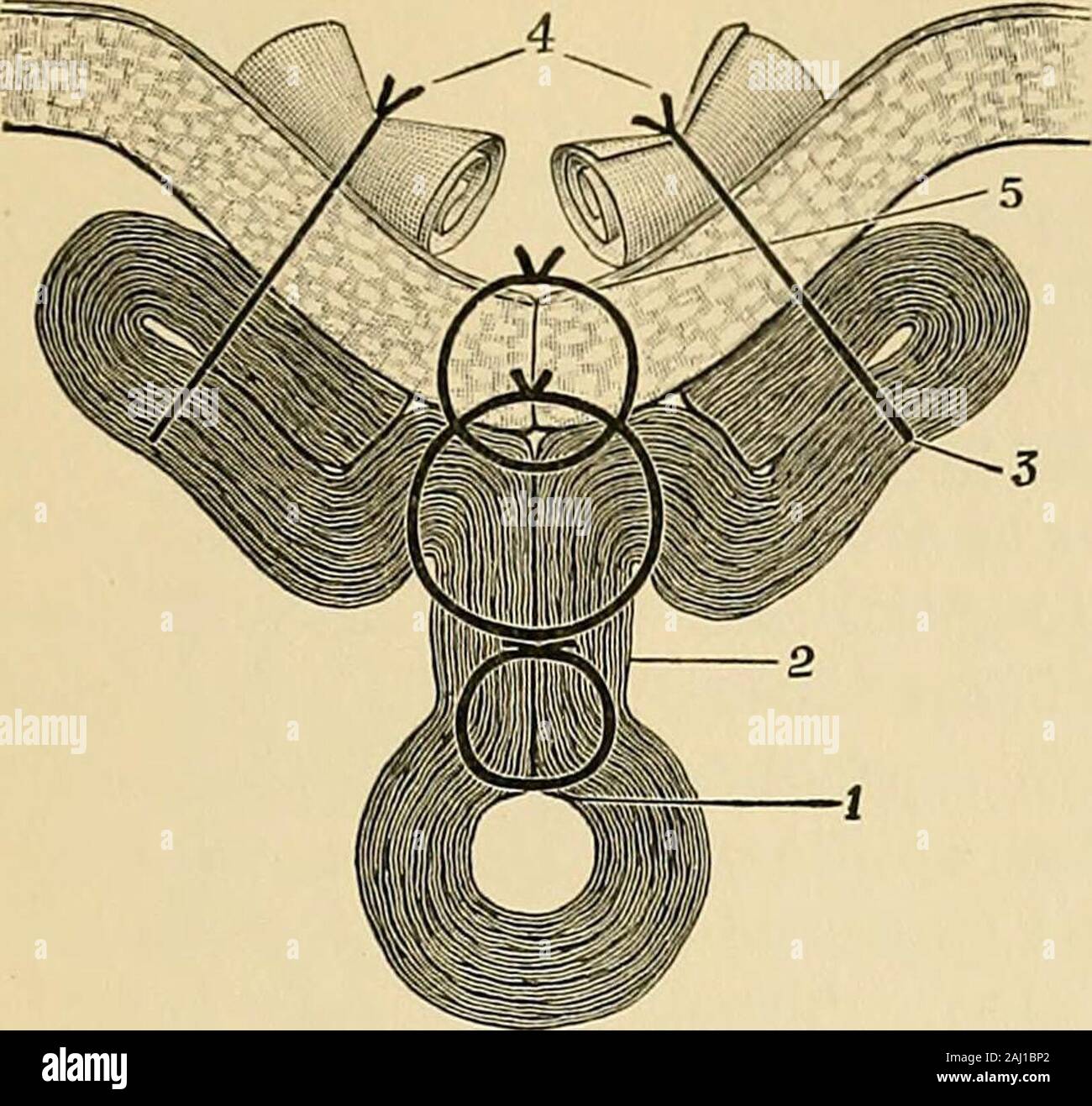 Operative surgery . Fig. 244.—Tlie sacciform aneurism, withcatheter ...