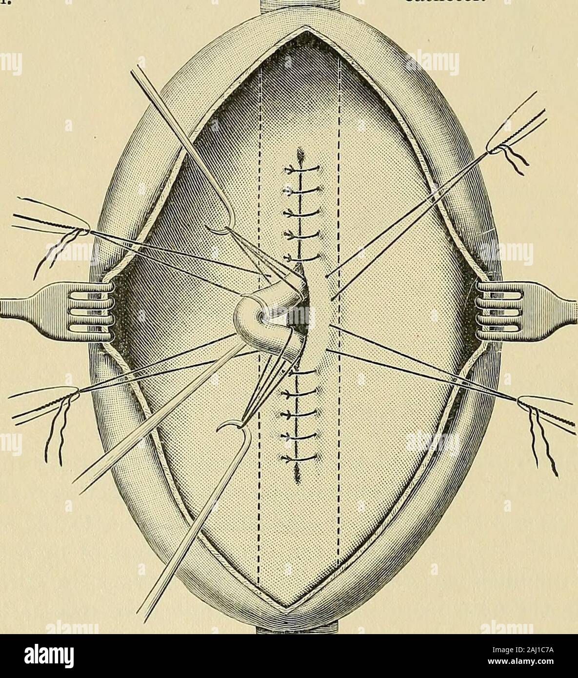 Operative surgery . Fig. 243.—The sacciform aneurism. Ob-literation of ...