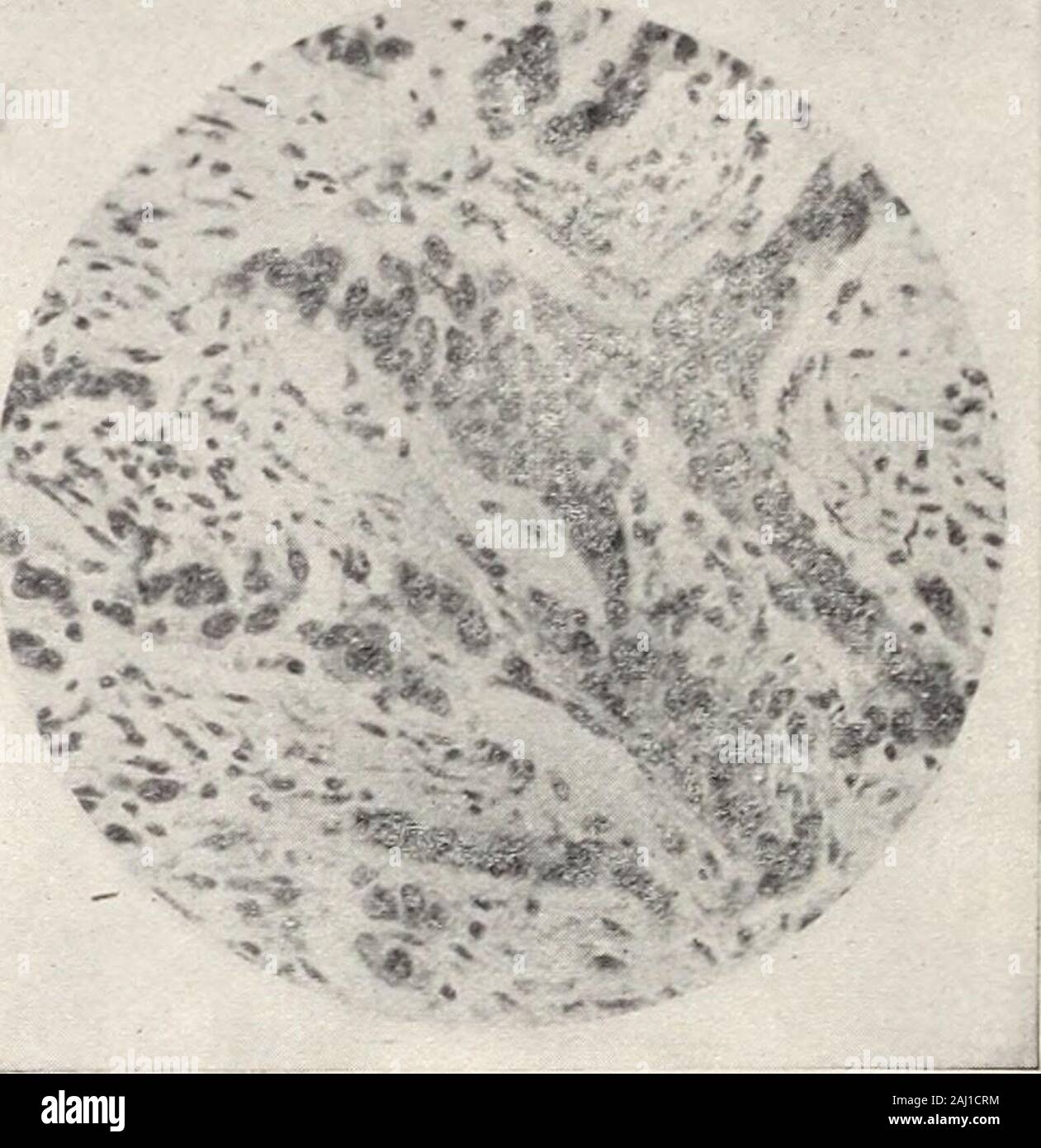 Mt Sinai Hospital Reports . Fig 6 Papillary carcinoma, showing atypical ...