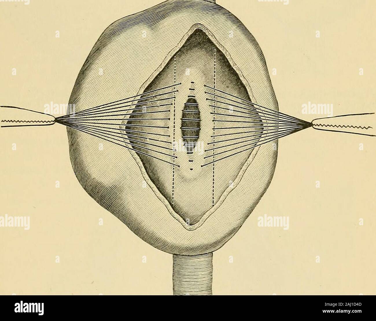 Blunt forceps hi-res stock photography and images - Alamy