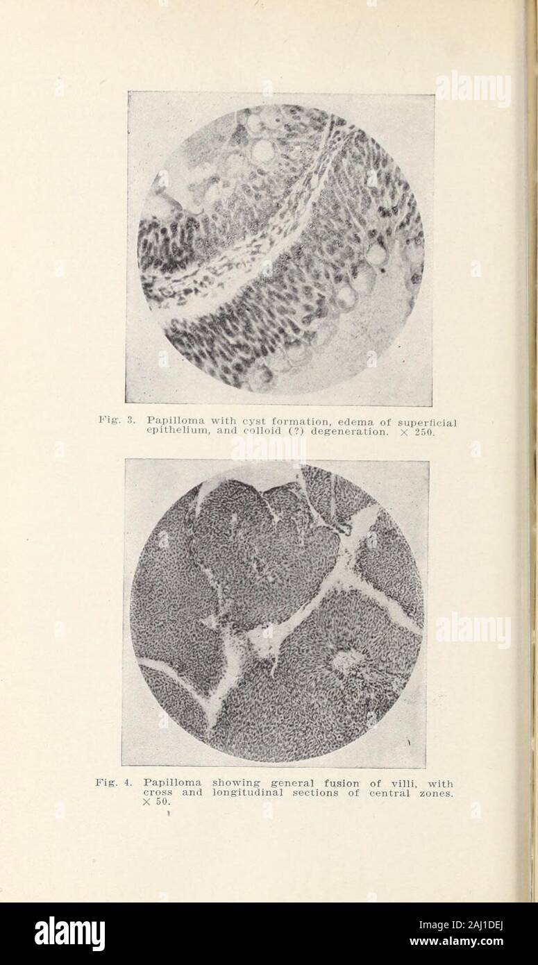 Mt Sinai Hospital Reports . Fig. 2. Papilloma, showing fusion of two ...
