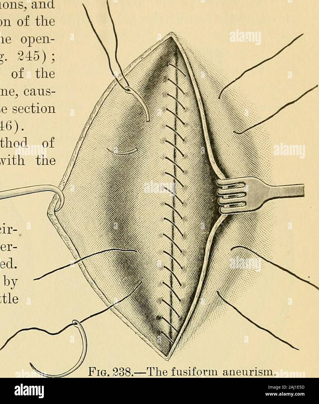 Ligature of arteries hi-res stock photography and images - Alamy