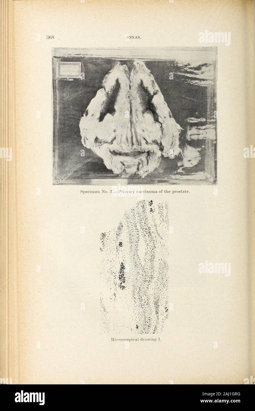 Rectal stricture hi-res stock photography and images - Alamy
