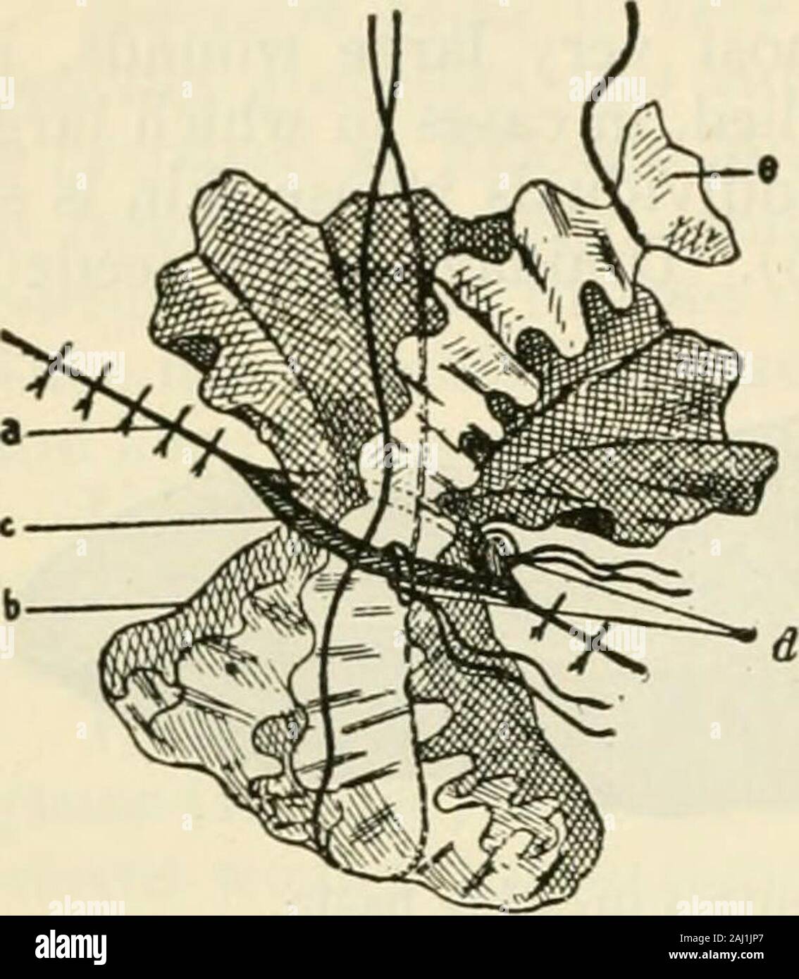 Modern surgery, general and operative . Fig. 41.—Plain dressing basin ...