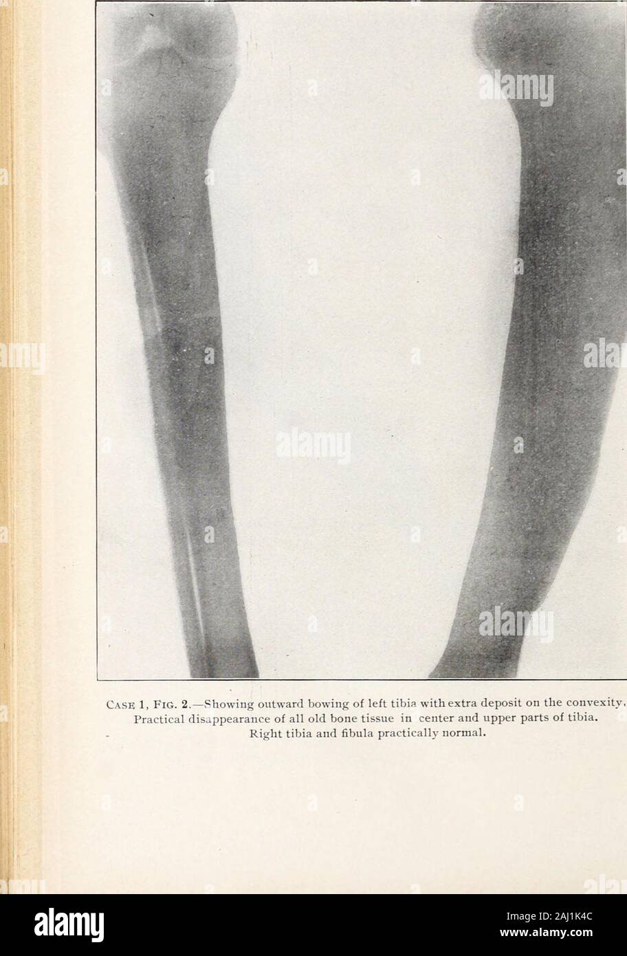 Interstate medical journal . forward and the femora outward; the pelvis ...