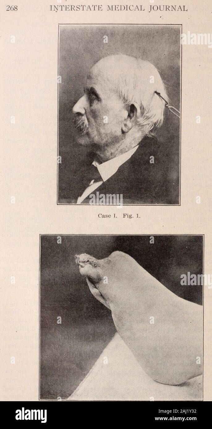 Lupus erythematosus on face hi-res stock photography and images - Alamy