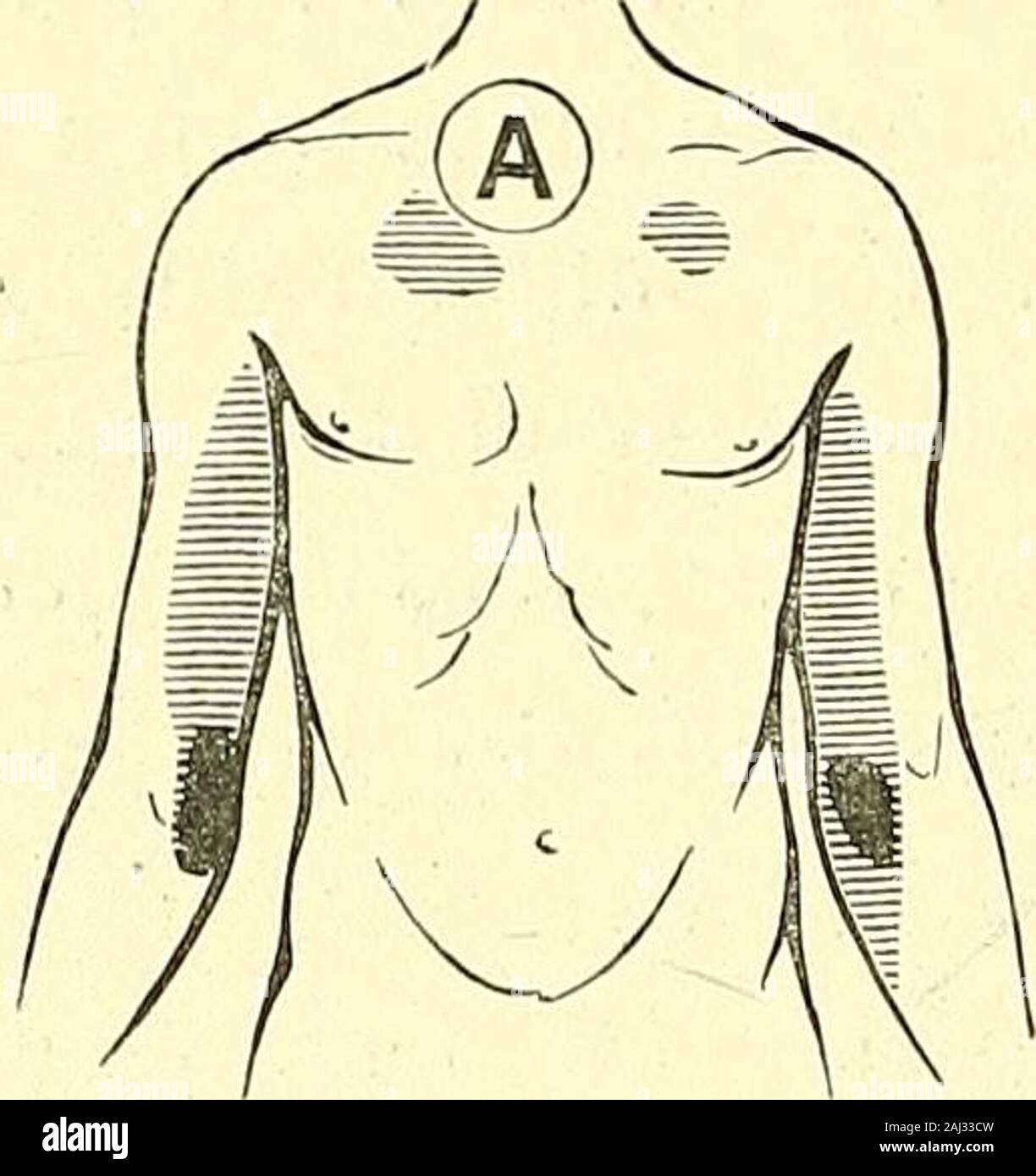 Intercostal nerves hi-res stock photography and images - Alamy