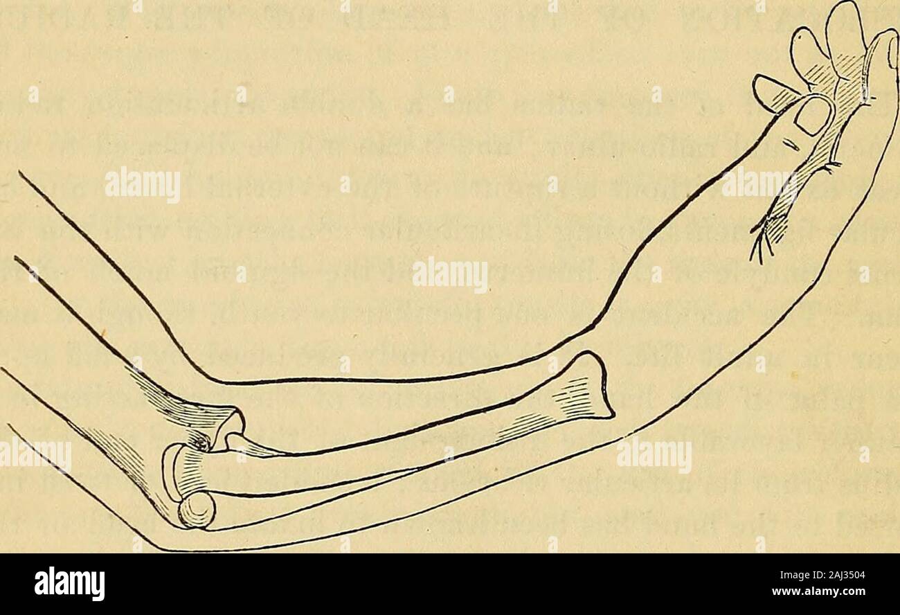 A practical and systematic treatise on fractures and dislocations ...