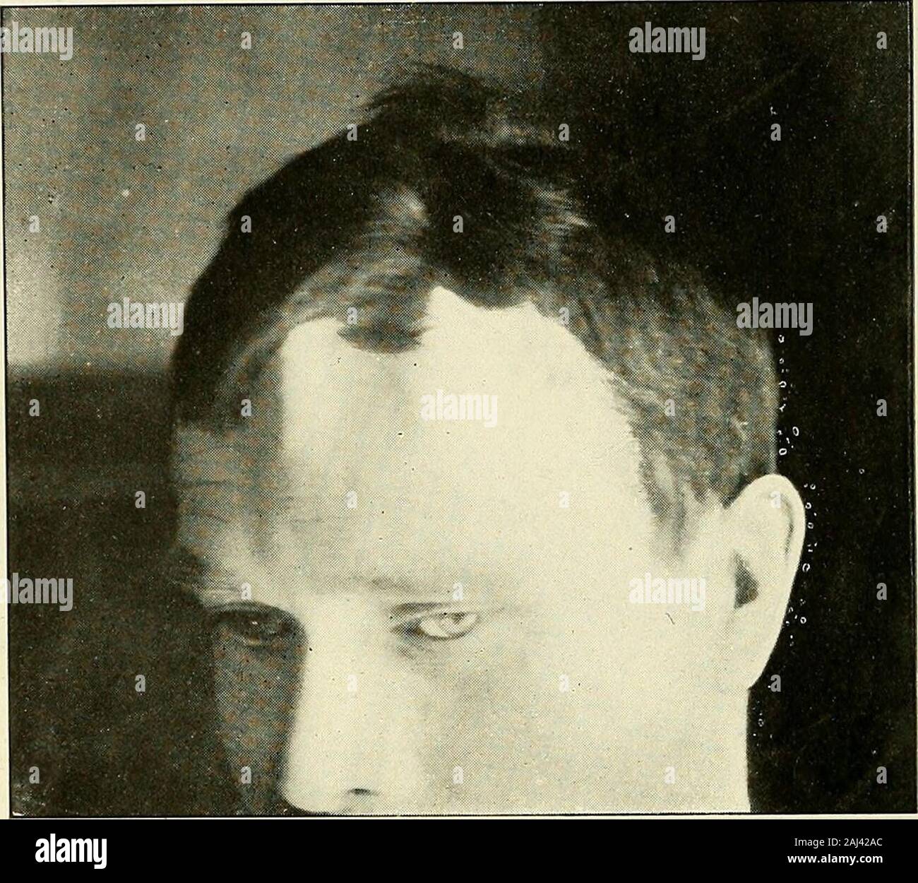 Les syphilides hi-res stock photography and images - Alamy