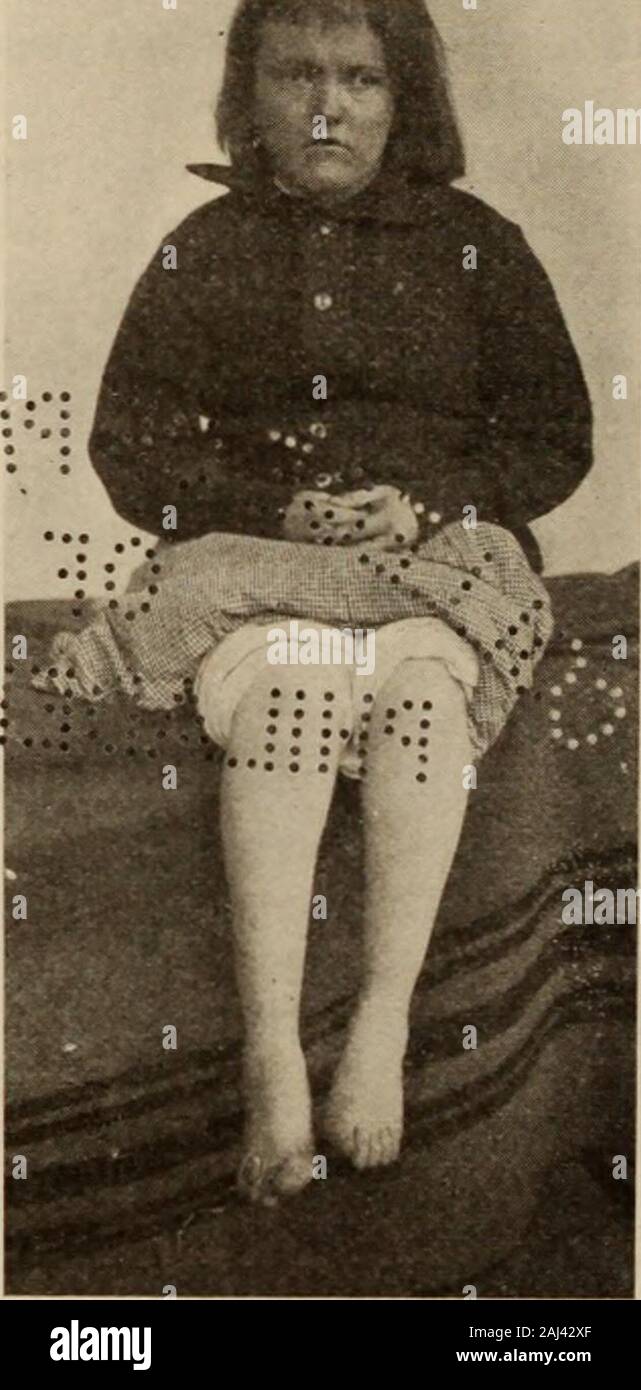 Interstate medical journal . ig. 2.—Case 1. Right-sided paralysis ...