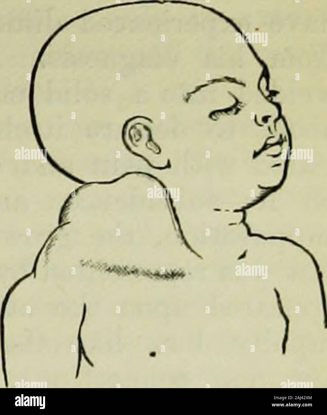 The surgical diseases of children . the growthis seen as a ragged ...