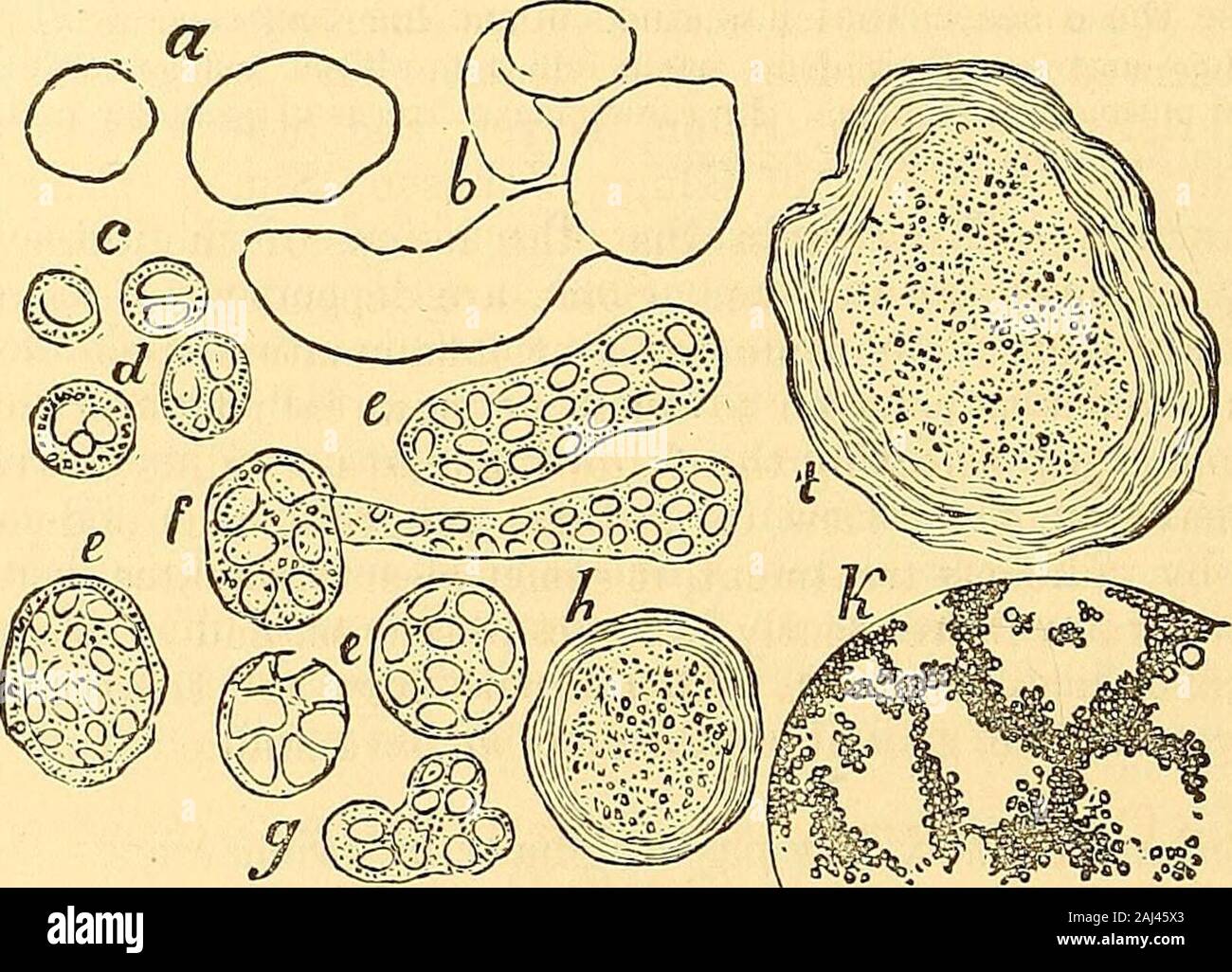 Colloid cysts hi-res stock photography and images - Alamy
