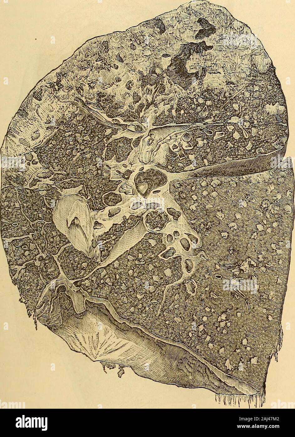 Phthisis pulmonalis hi-res stock photography and images - Alamy