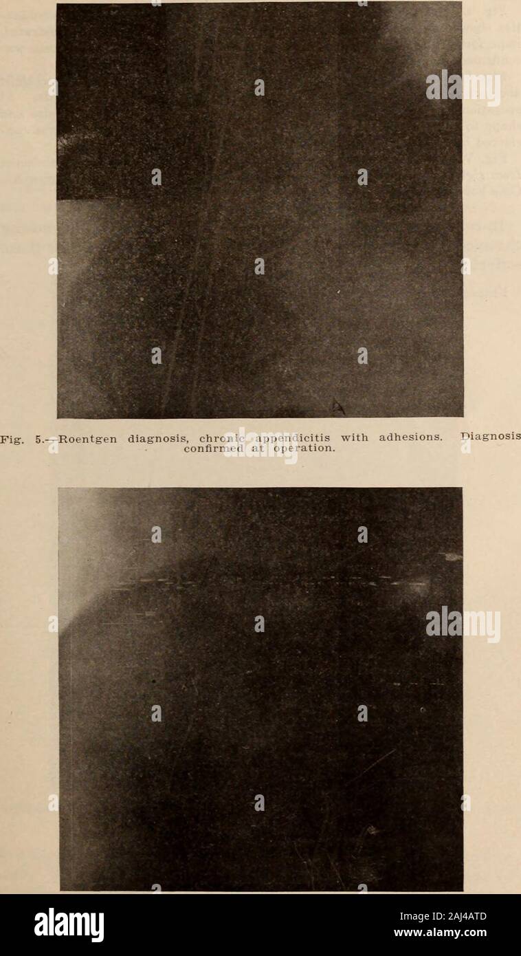 Interstate medical journal . -Fig. 4.—Roentgen diagnosis, chronic ...