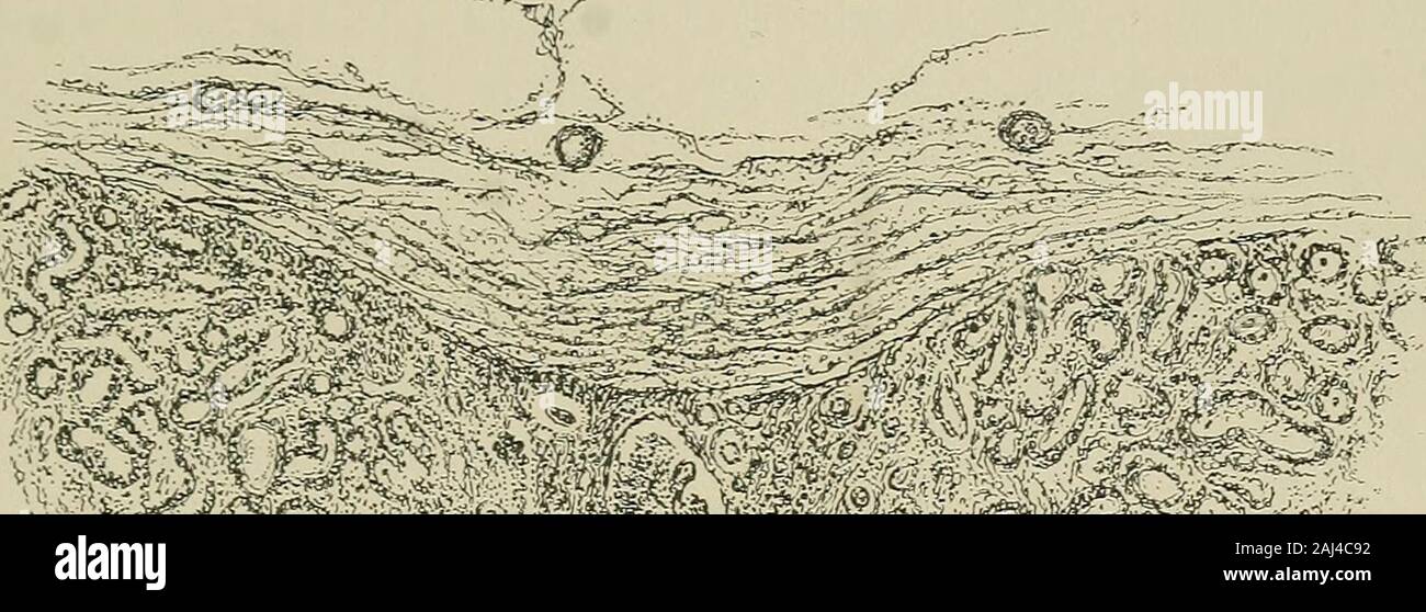 Area contracted disease hi-res stock photography and images - Alamy