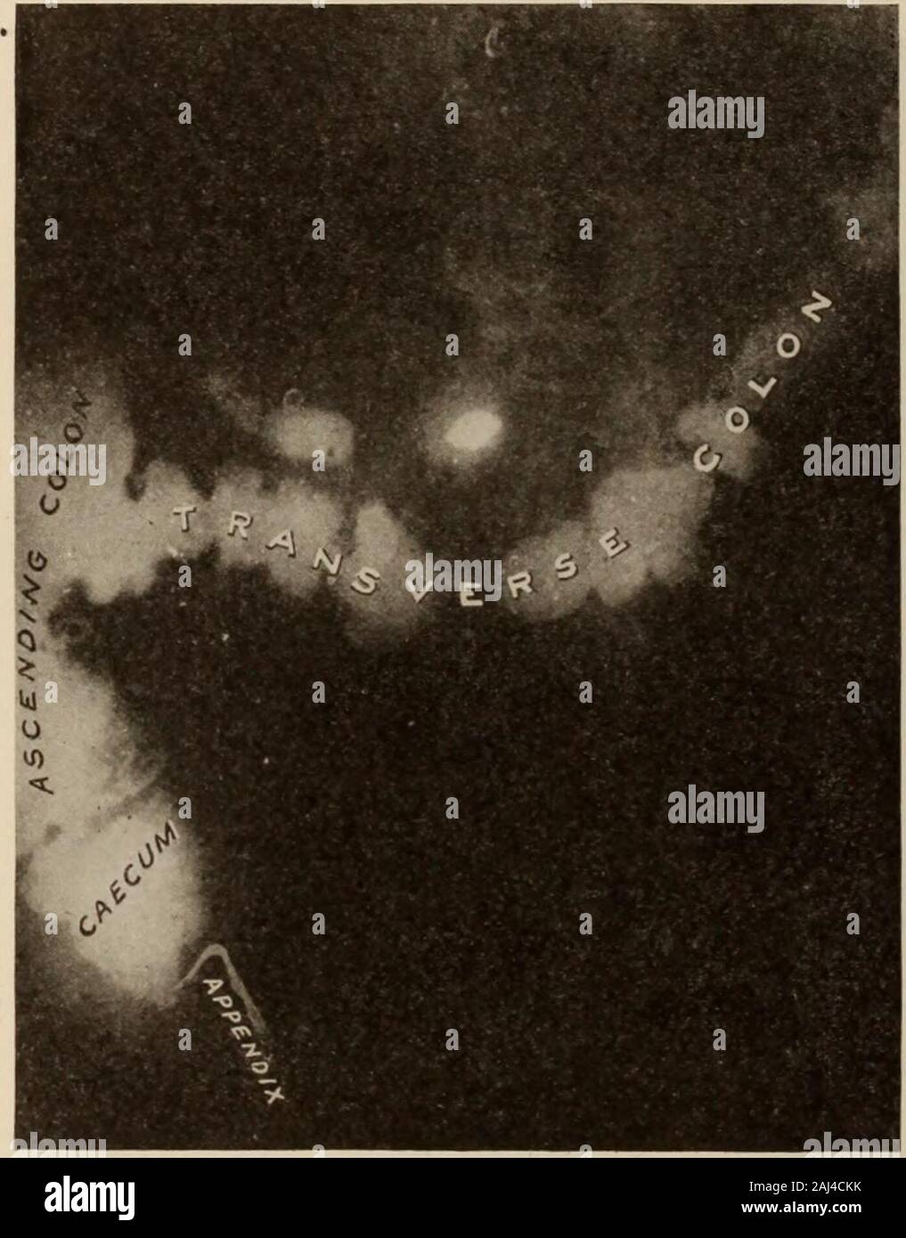 Interstate medical journal . nalcap. The six hour plate (Fig. 2) shows ...
