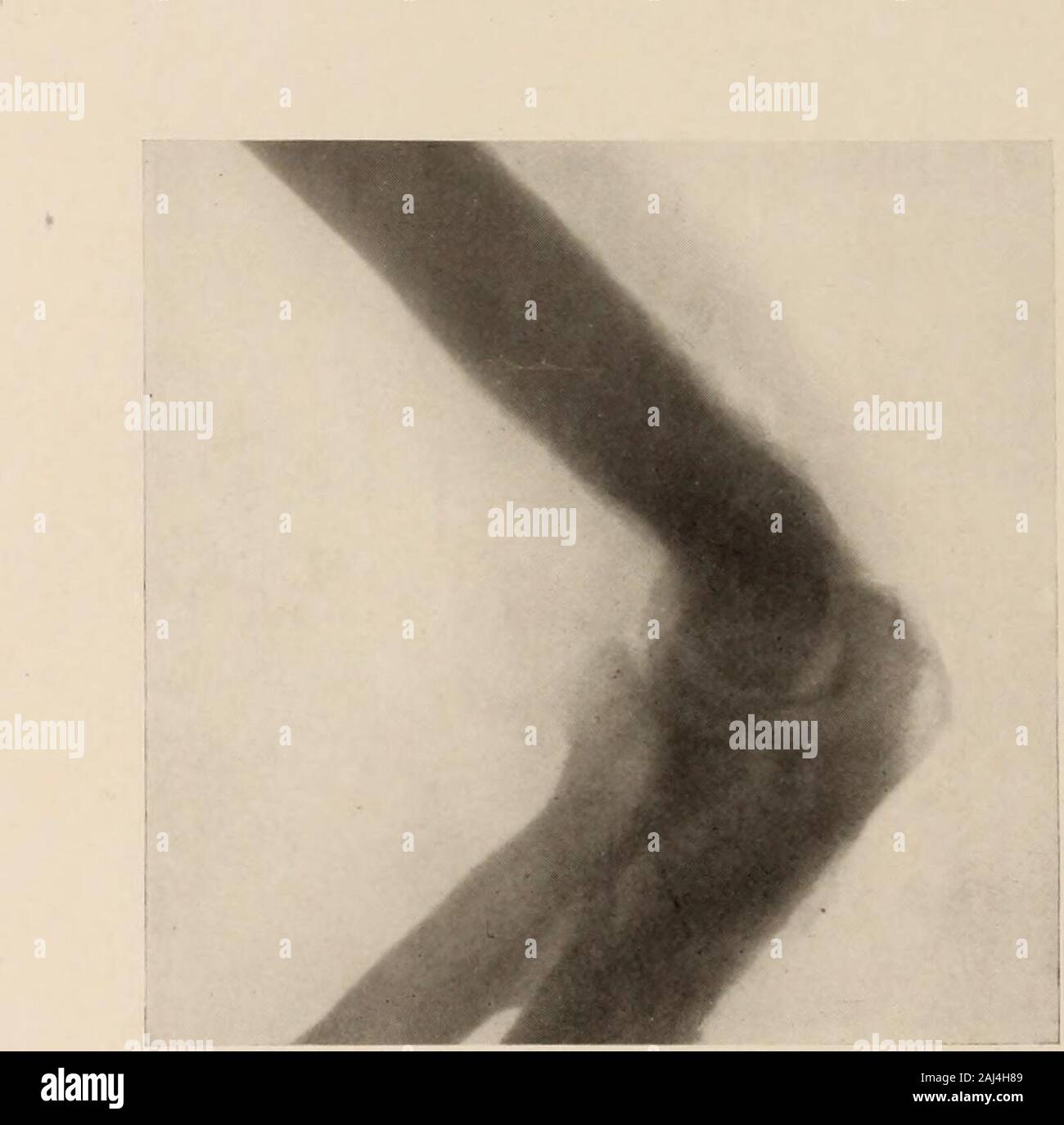 Interstate medical journal . Fig. 6.—Syphilis of the elbow. OReilly ...