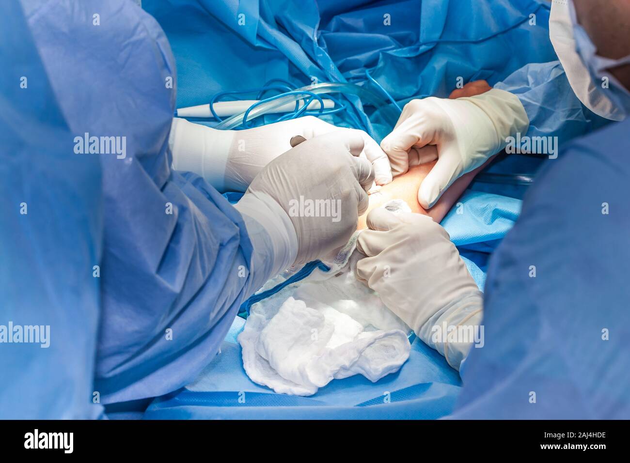 Group of surgeons performing an elbow surgery Stock Photo - Alamy