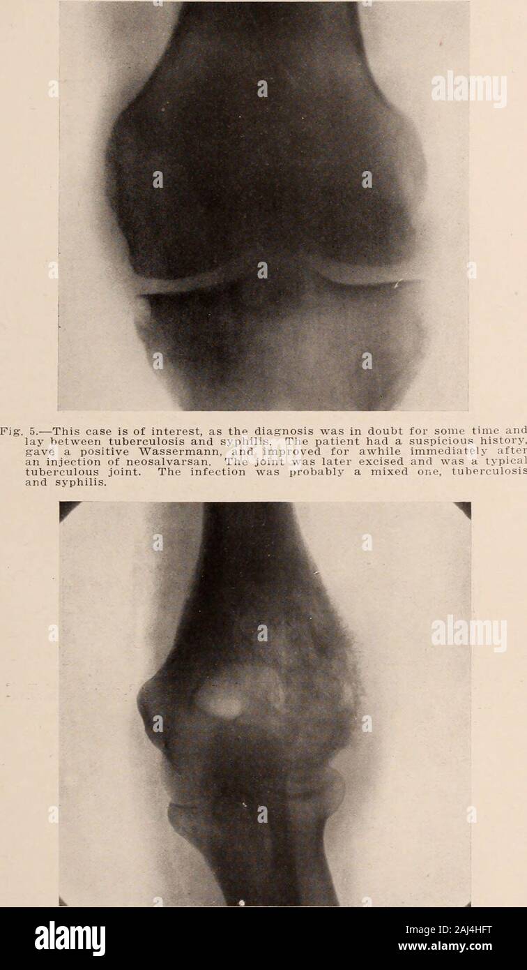 Interstate medical journal . Fig. 4.—Marked atrophy of the joint ...