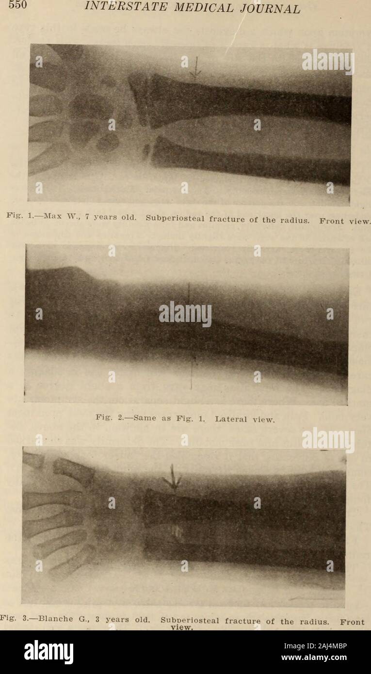 Fork deformity hi-res stock photography and images - Alamy