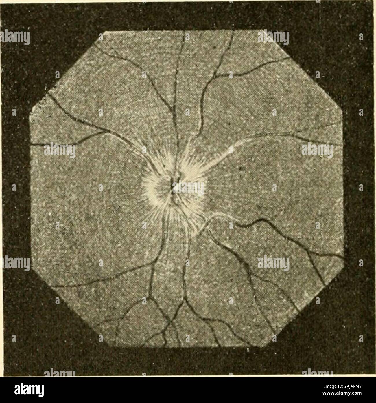 Neuroretinitis hi-res stock photography and images - Alamy