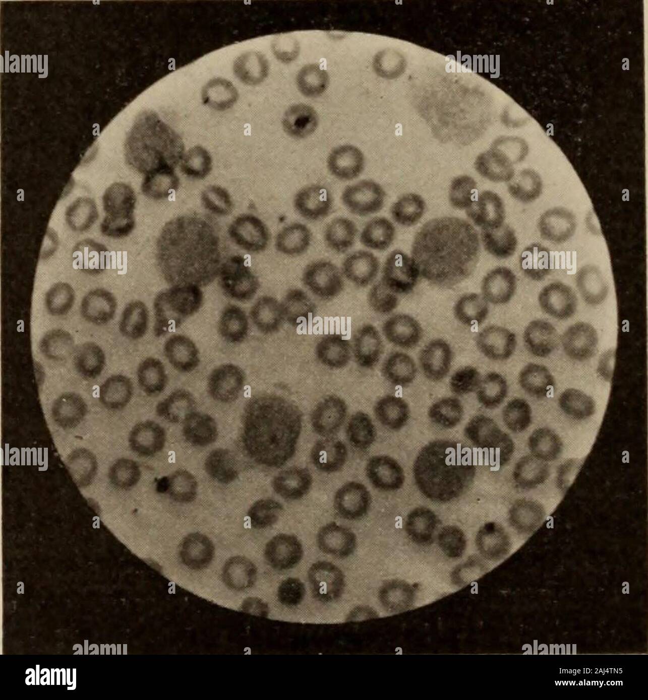 Basophilia Of Chromatin Full Article: Acute Basophilic Leukemia