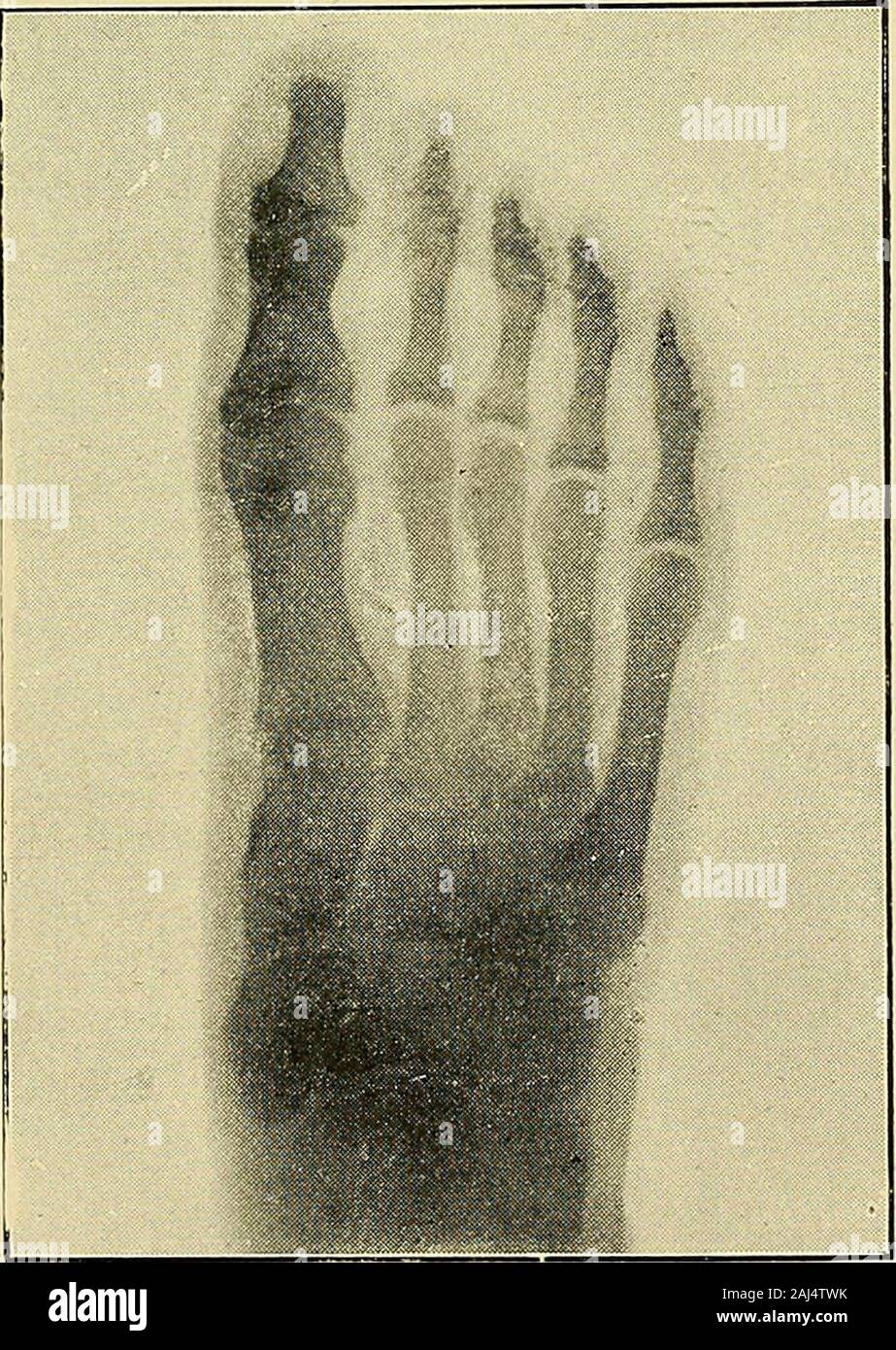 Foreign body in foot hi-res stock photography and images - Alamy