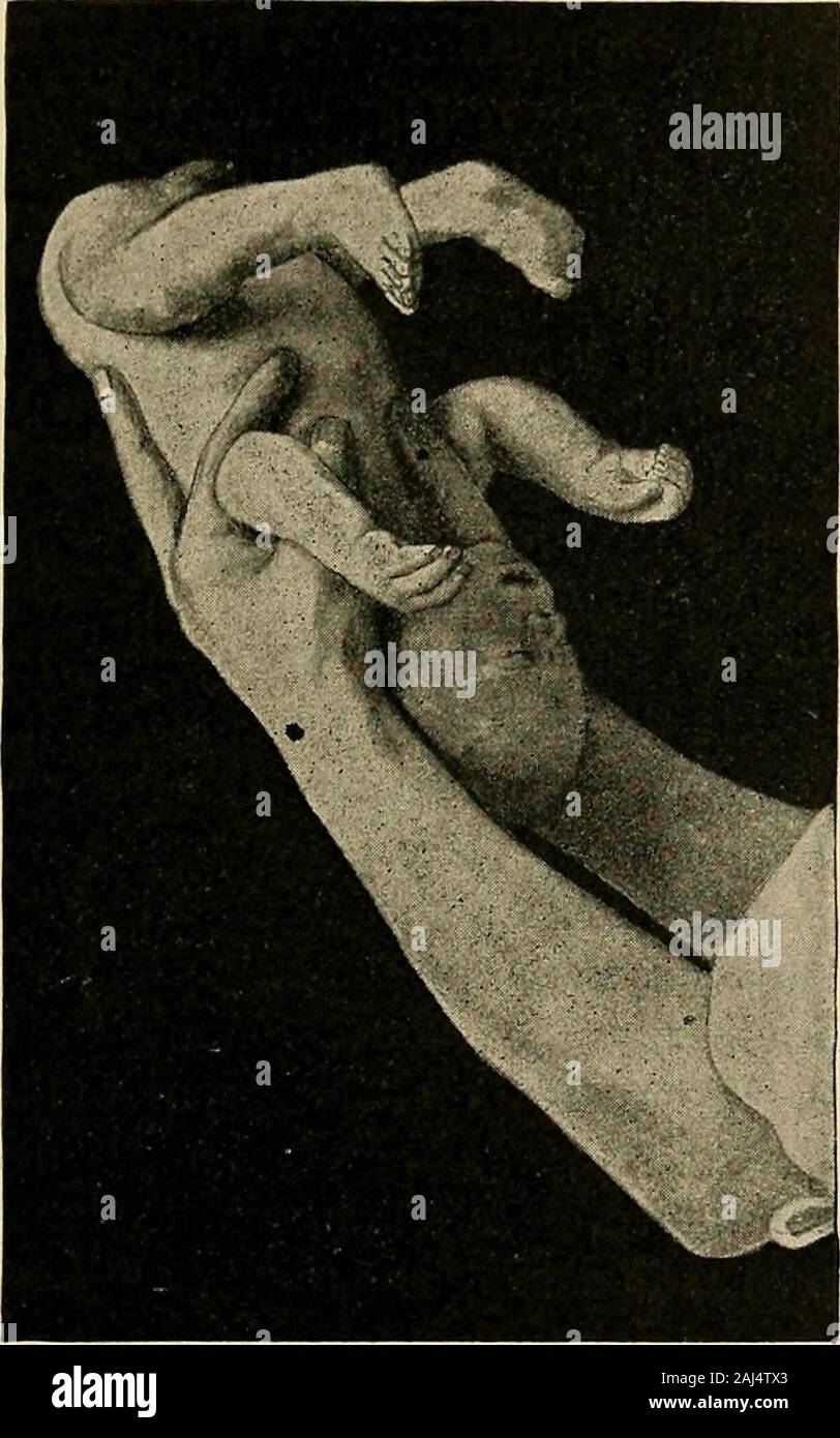 A manual of obstetrics . Fig. i6o.—Schultzes method of respiration ...