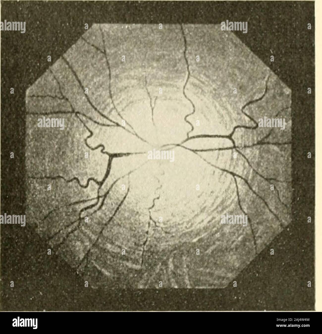 Macula lutea hi-res stock photography and images - Alamy