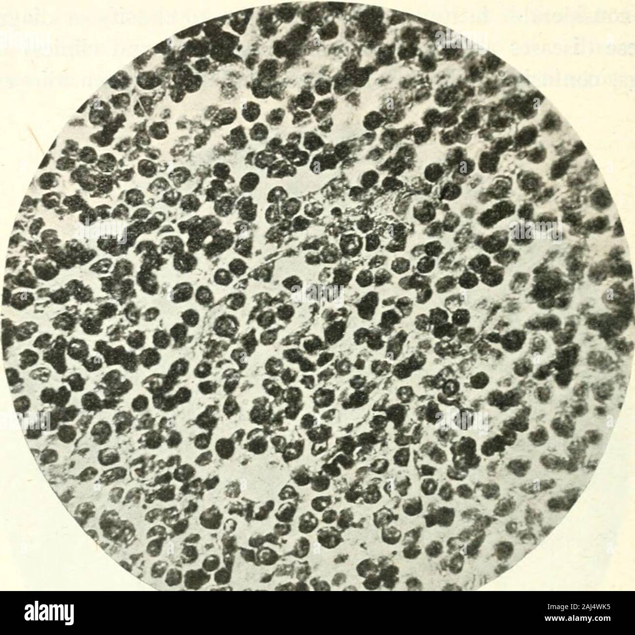 Marrow hyperplasia hi-res stock photography and images - Alamy