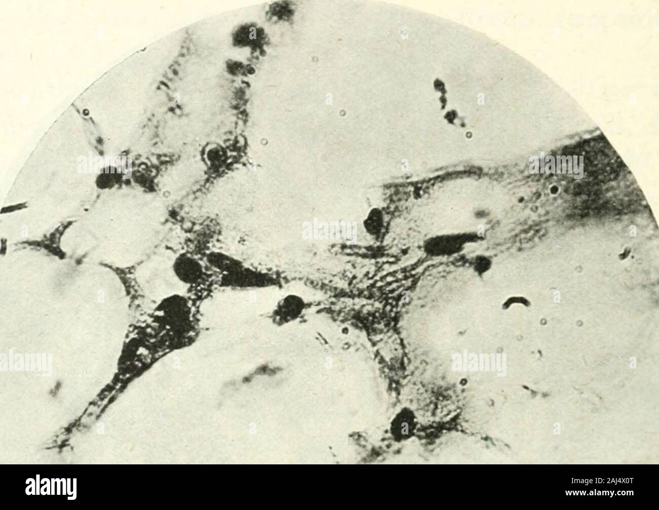 The Medical clinics of North America . Fig. 85.—Case III. Rib marrow ...