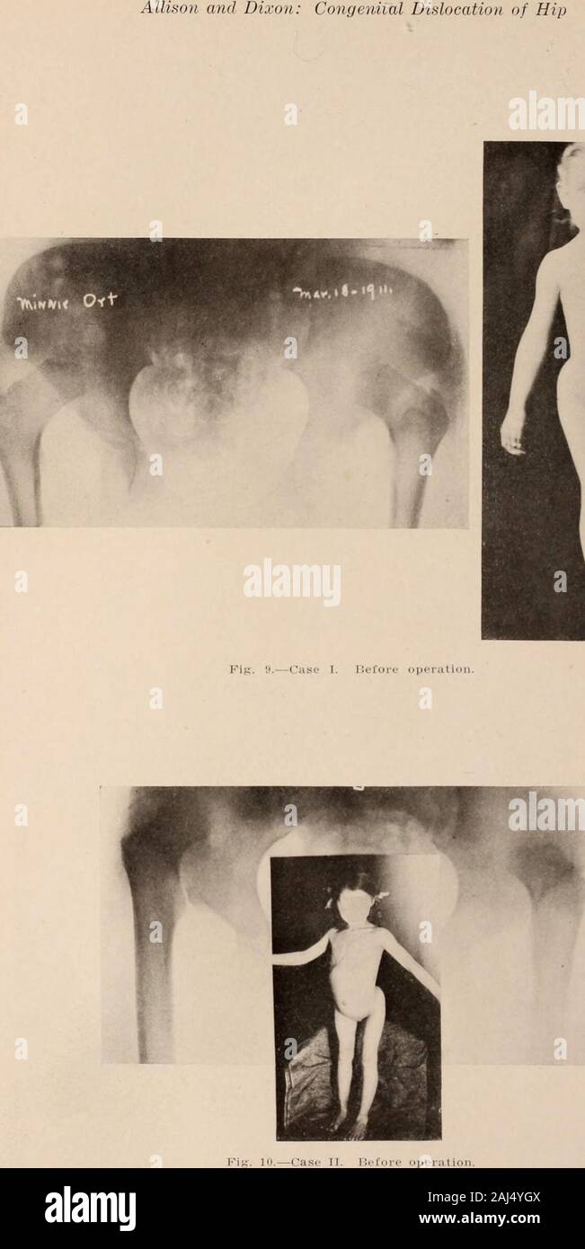 Interstate medical journal . Allison and Dixon: Congenital Dislocation ...