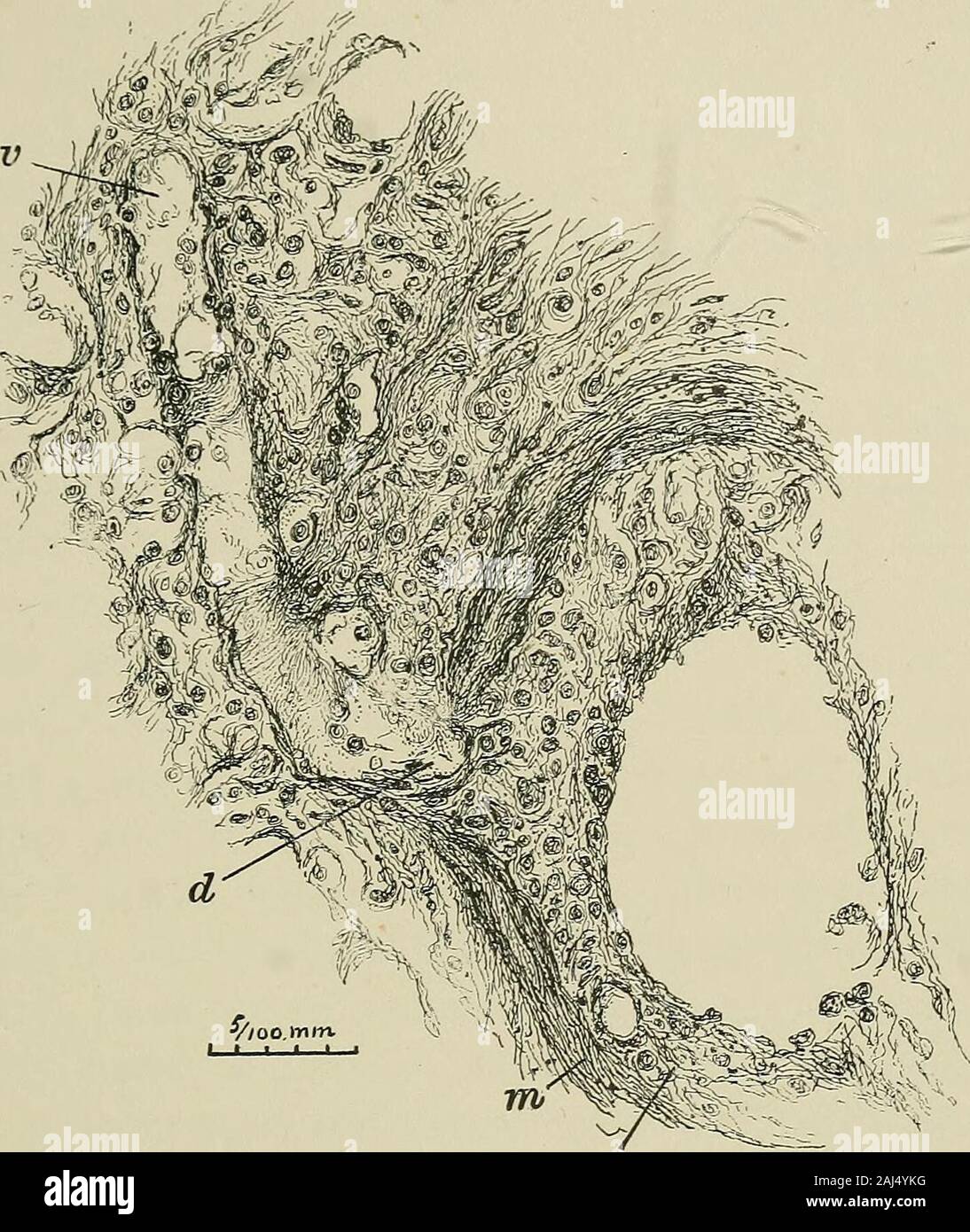 Endarteritis High Resolution Stock Photography and Images - Alamy