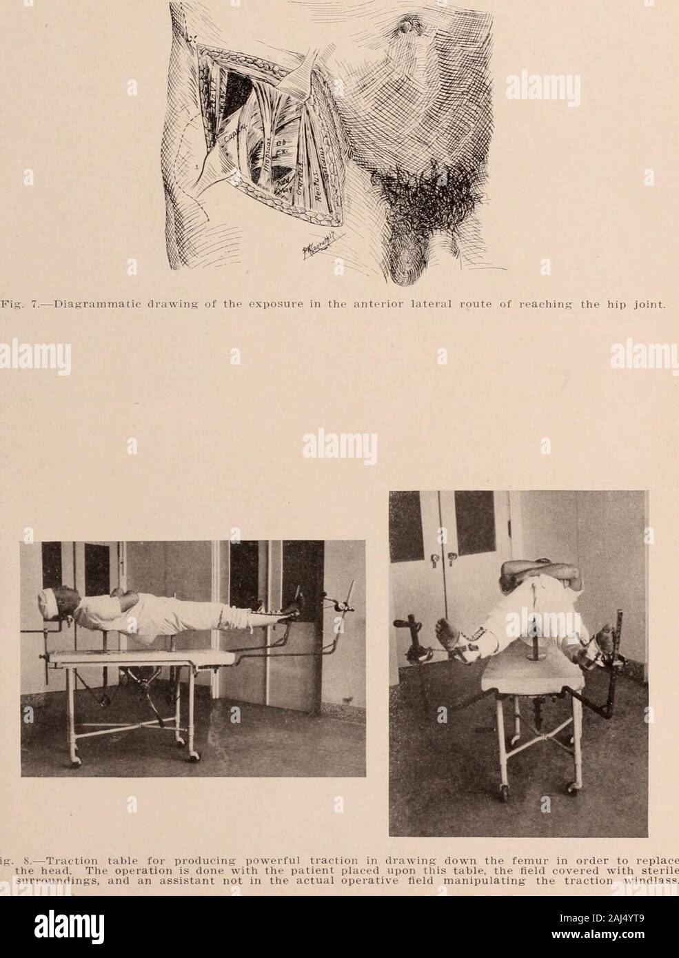 Congenital dislocation of the hip hi-res stock photography and images ...