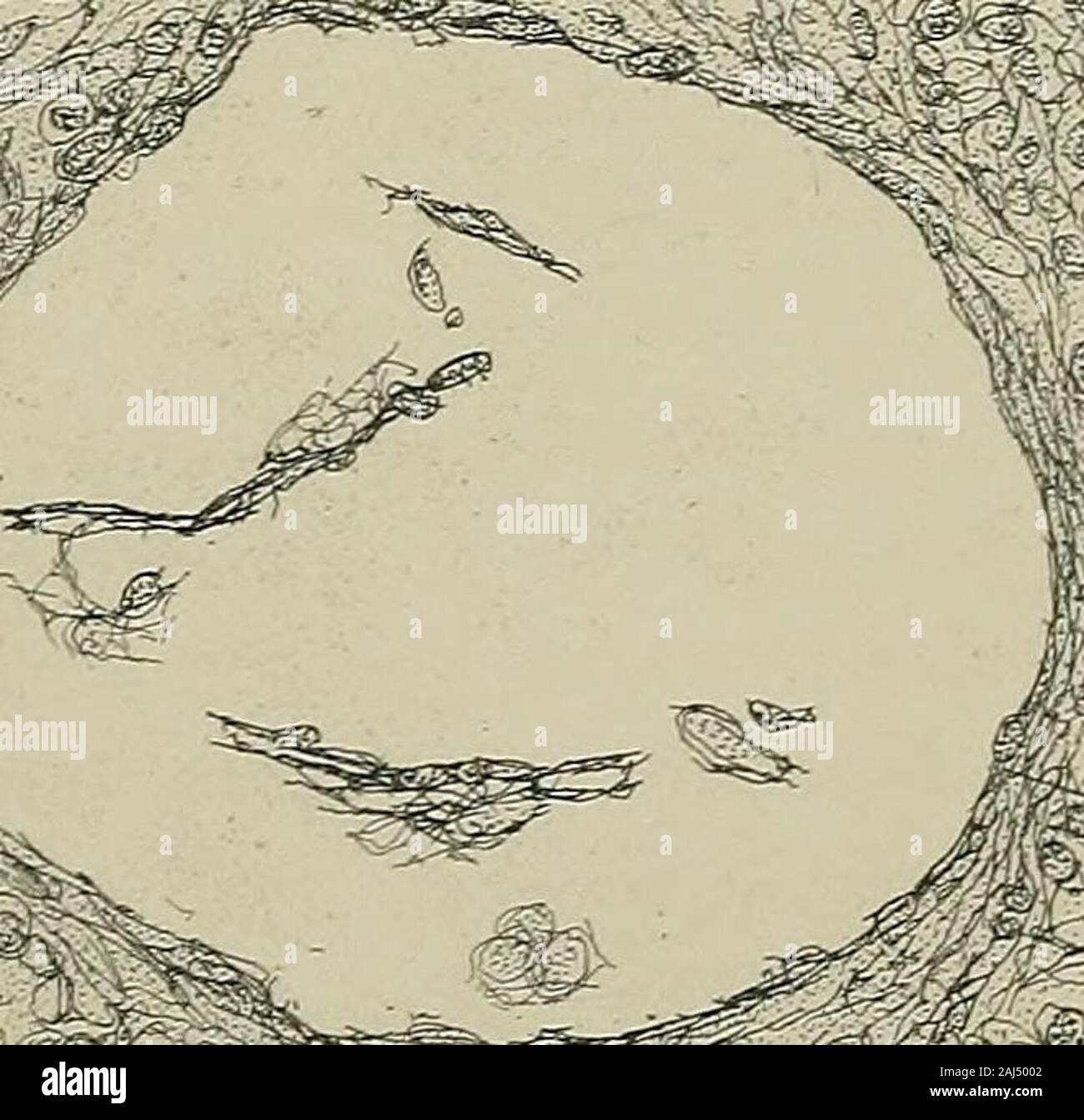 Endarteritis hi-res stock photography and images - Alamy