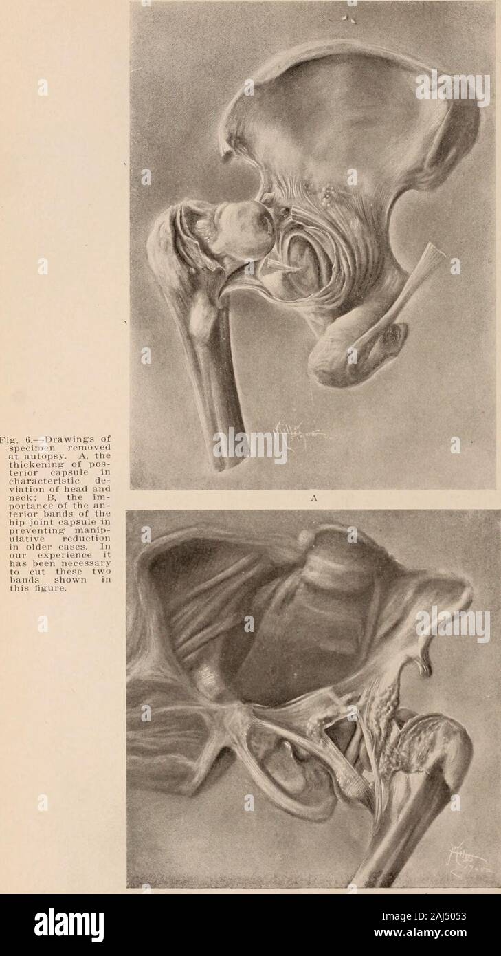 Congenital dislocation of the hip hi-res stock photography and images ...