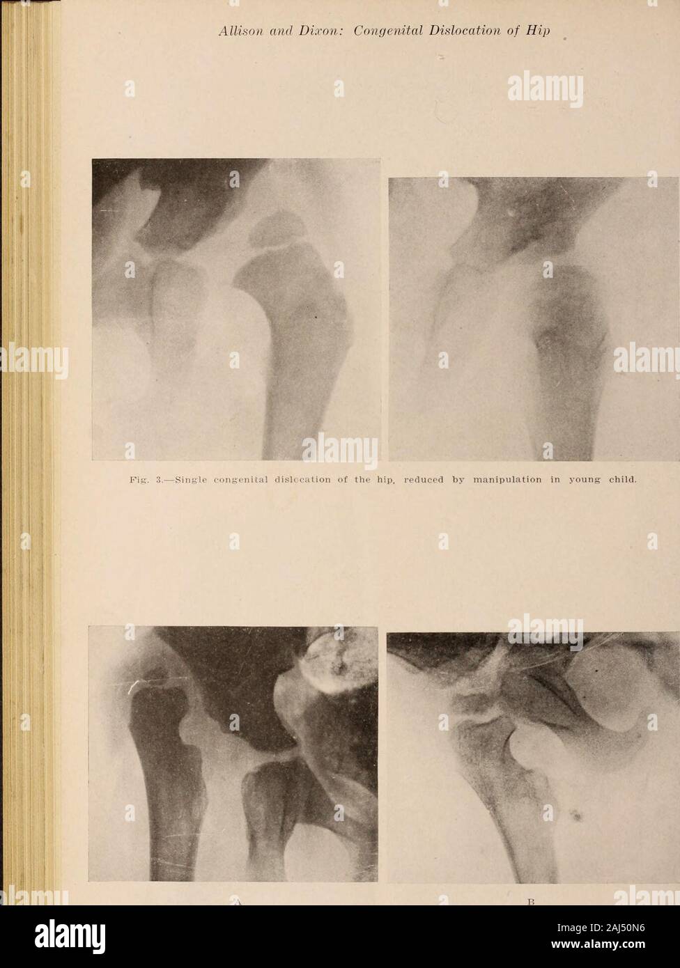 Interstate medical journal . Fig. 2.—Single congenital dislocation of ...