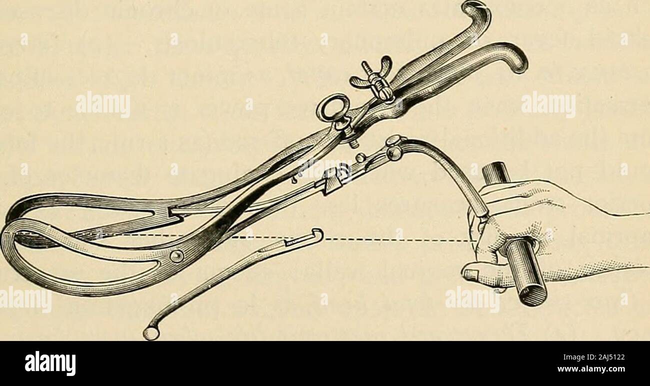 A manual of obstetrics . Fit;. 146.—Forceps of Hodge. sinks. The lock ...