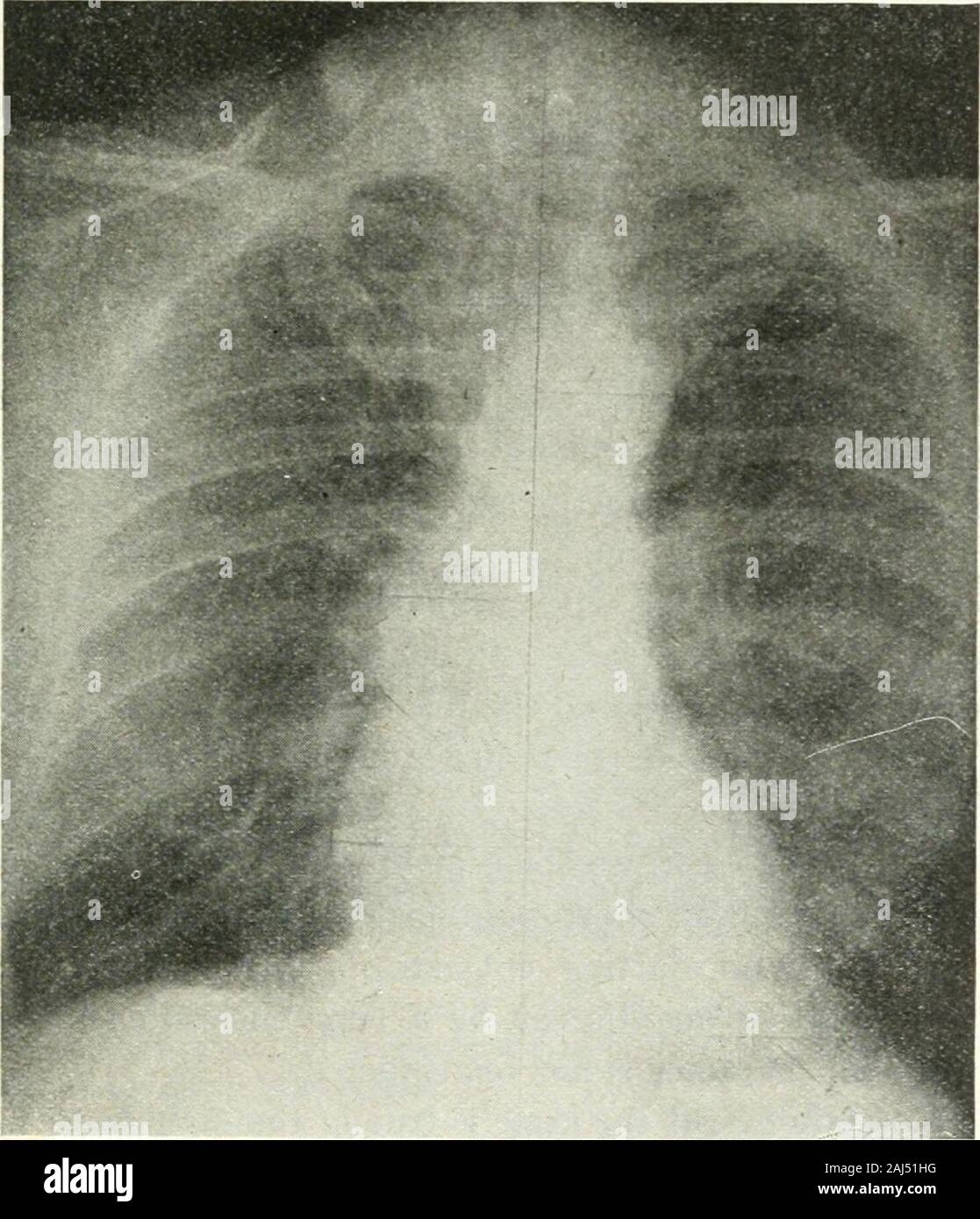 Bulging chest hi-res stock photography and images - Alamy