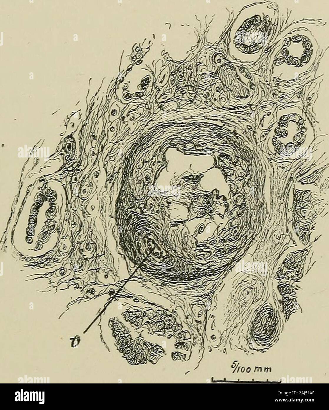 Endarteritis hi-res stock photography and images - Alamy